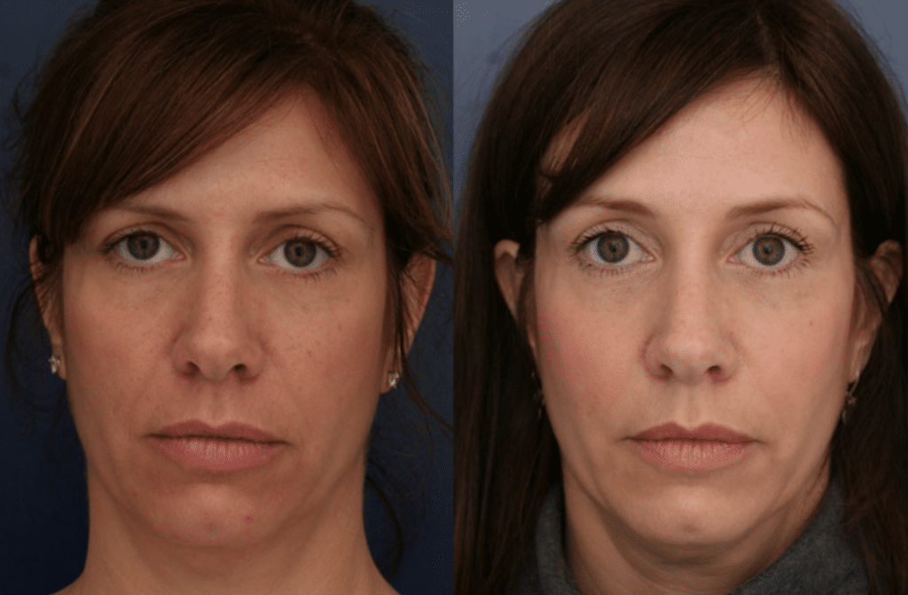 Blepharoplasty vs. Brow Lift Surgery - Blog - Ronald Schuster Plastic ...